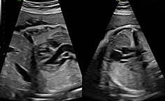 Voluson E10 | GE Healthcare