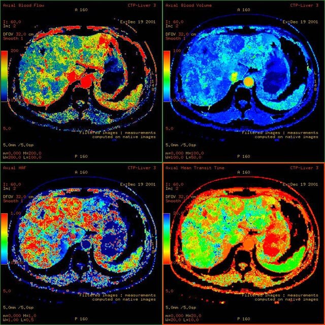 CT Perfusion 4D Multi-organs | GE Healthcare