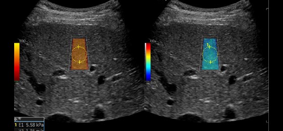 LOGIQ™ E10 Ultrasound | GE Healthcare