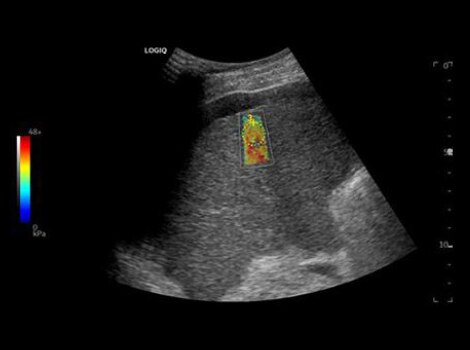 LOGIQ™ E10 Ultrasound | GE Healthcare