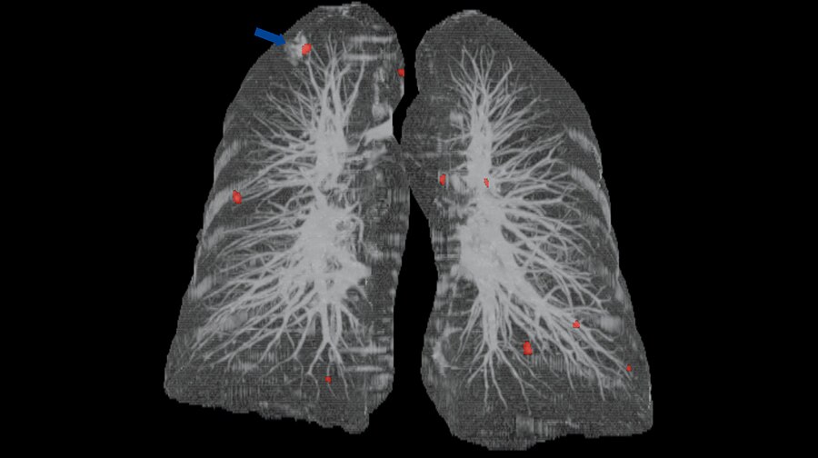 Lung VCAR | GE Healthcare