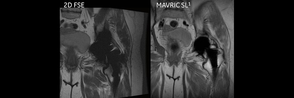 MAVRIC SL | GE Healthcare