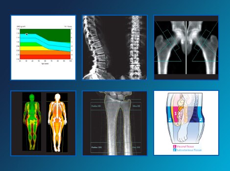 Lunar iDXA | GE Healthcare