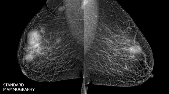 SenoBright HD Contrast Mammography | GE Healthcare