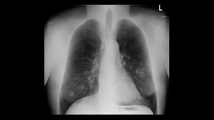 Dual Energy Subtraction | GE Healthcare