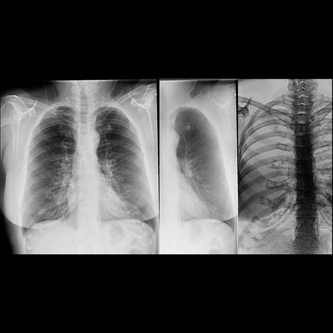 Dual Energy Subtraction | GE Healthcare (United States)