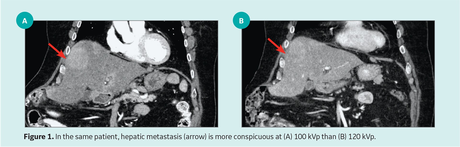 Routine 100 kVp Imaging Delivers High Image Contrast at Low Dose | GE ...