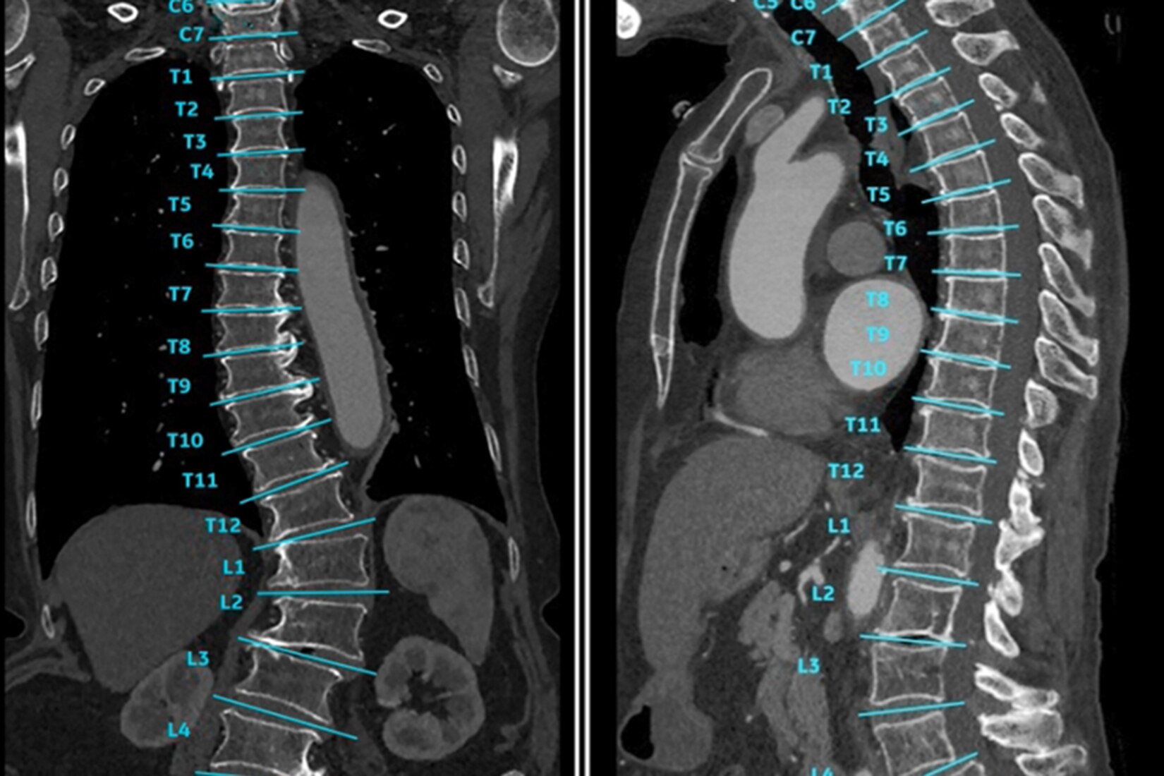 Spine Auto Views | GE HealthCare (United States)