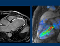 Cardiac magnetic resonance imaging with deep-learning | GE HealthCare ...