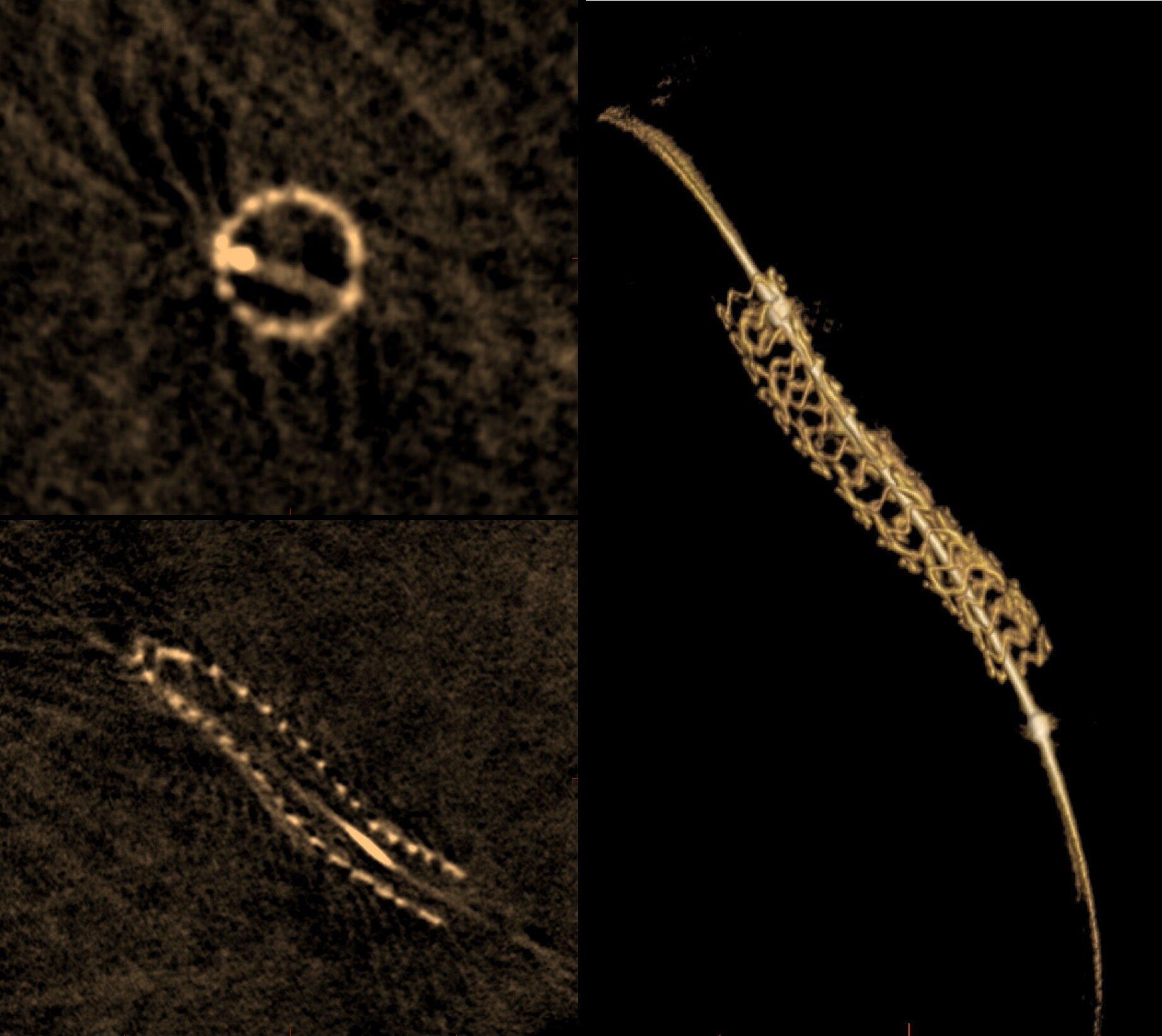 3D Coronary Stent Visualization | GE HealthCare (United States)