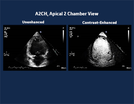 Optison | GE HealthCare (United States)