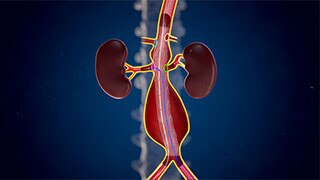 EVAR ASSIST 2 | GE HealthCare (United States)