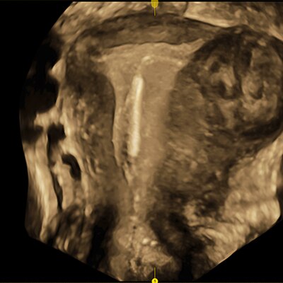 Voluson™ | Women’s Health Ultrasound | GE Healthcare (Singapore)