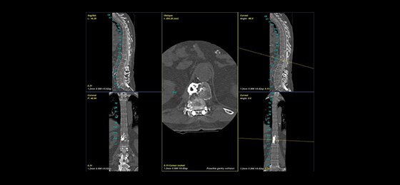 Bone Vcar Advanced Visualization for Computed Tomography | GE ...