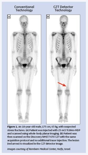 General Purpose CZT Detector Represents a New Era in Nuclear Medicine ...