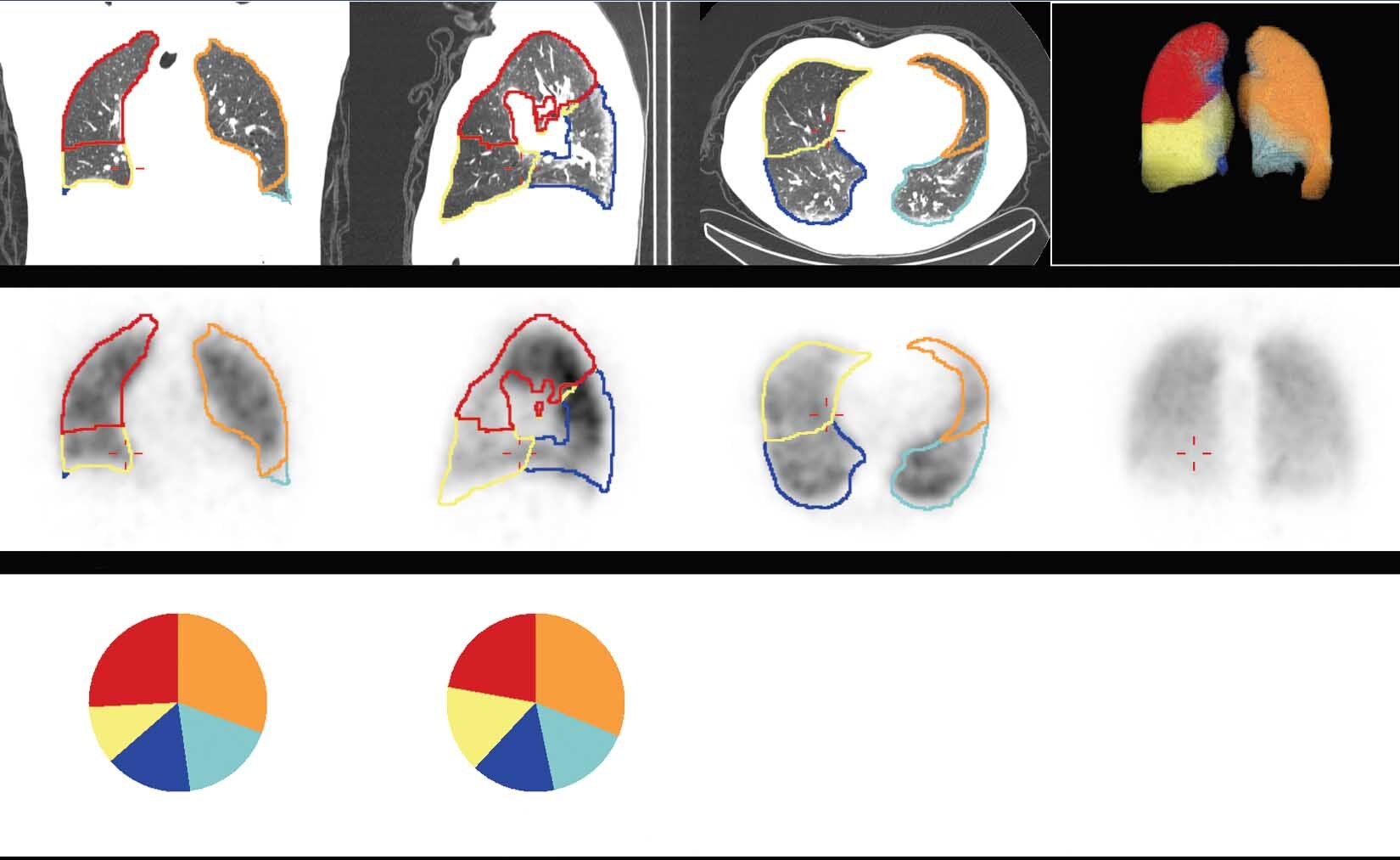 Lung Segments Vq