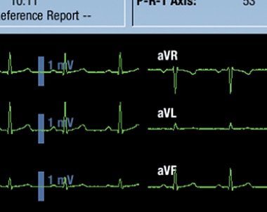 An introduction to 12RL ECG technology | GE HealthCare (United States)