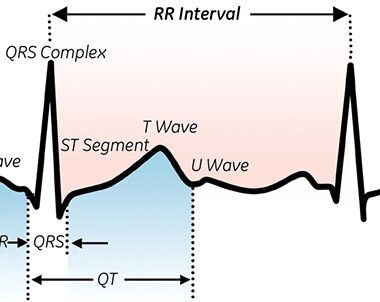 Monitoring of the QT Interval in Perioperative and Critical Care | GE ...