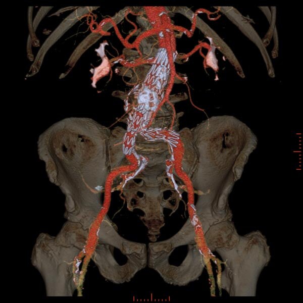 Autobone & VesselIQ Xpress | GE Healthcare (United States)
