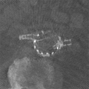 Discovery IGS 740 for Interventional Radiology and Oncology | GE ...