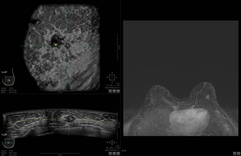 Clinical Evidence - Invenia ABUS - ABUS Breast Imaging - Ultrasound ...
