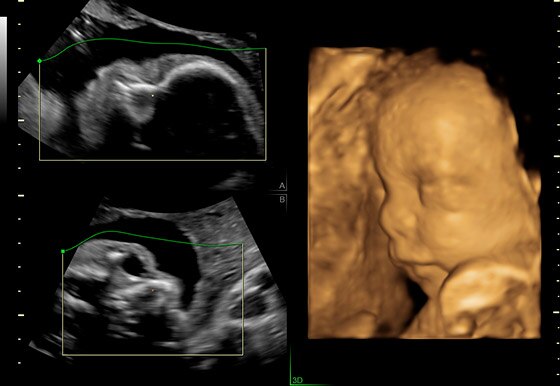 2D and 3D/4D Ultrasound | Voluson P8 | Voluson Performance series | GE ...