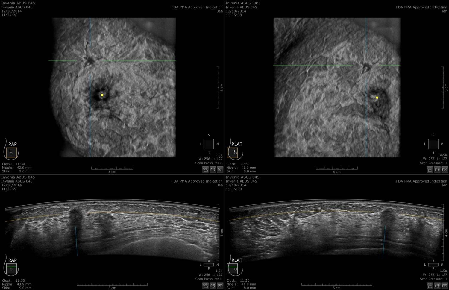 Clinical Evidence - Invenia ABUS - ABUS Breast Imaging - Ultrasound ...