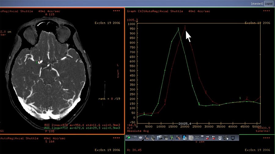 CT Perfusion 4D Neuro | GE Healthcare