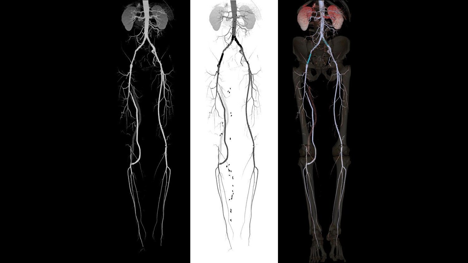 Autobone & VesselIQ Xpress | GE Healthcare