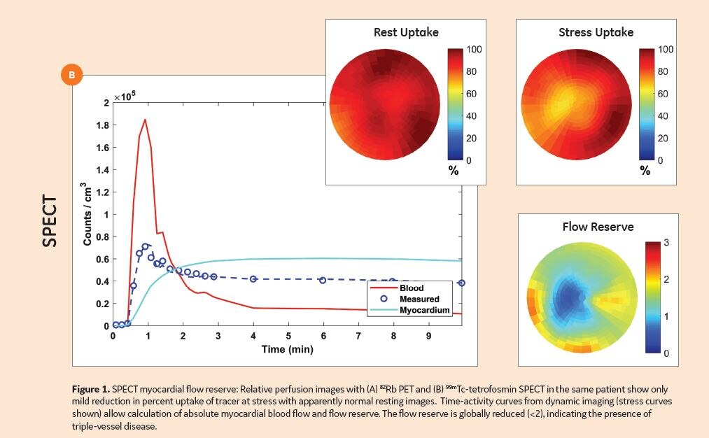SPECT for Evaluating Myocardial Blood Flow | GE Healthcare