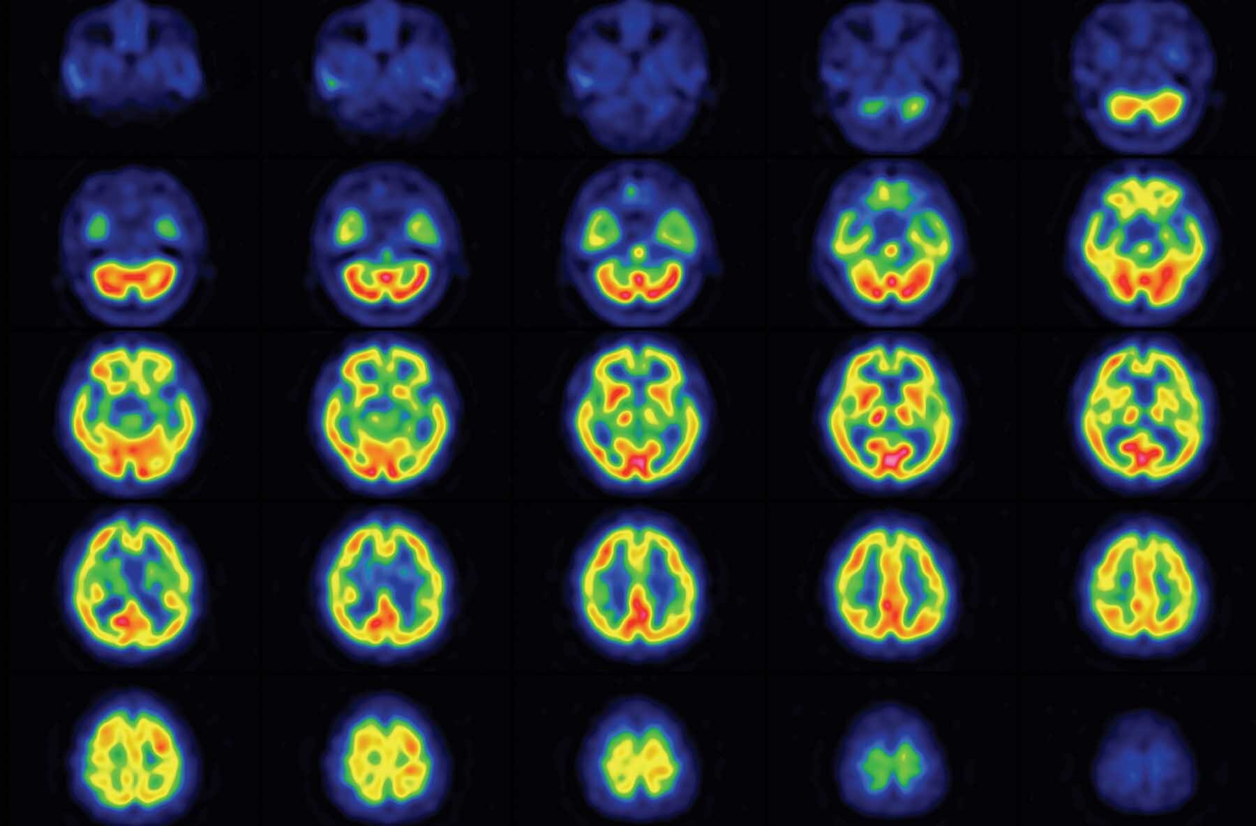 Short Acquisition Times with General Purpose CZT SPECT/CT System | GE ...