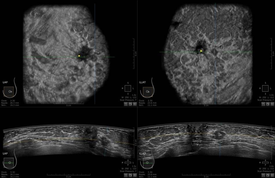 Clinical Evidence - Invenia ABUS - ABUS Breast Imaging - Ultrasound ...