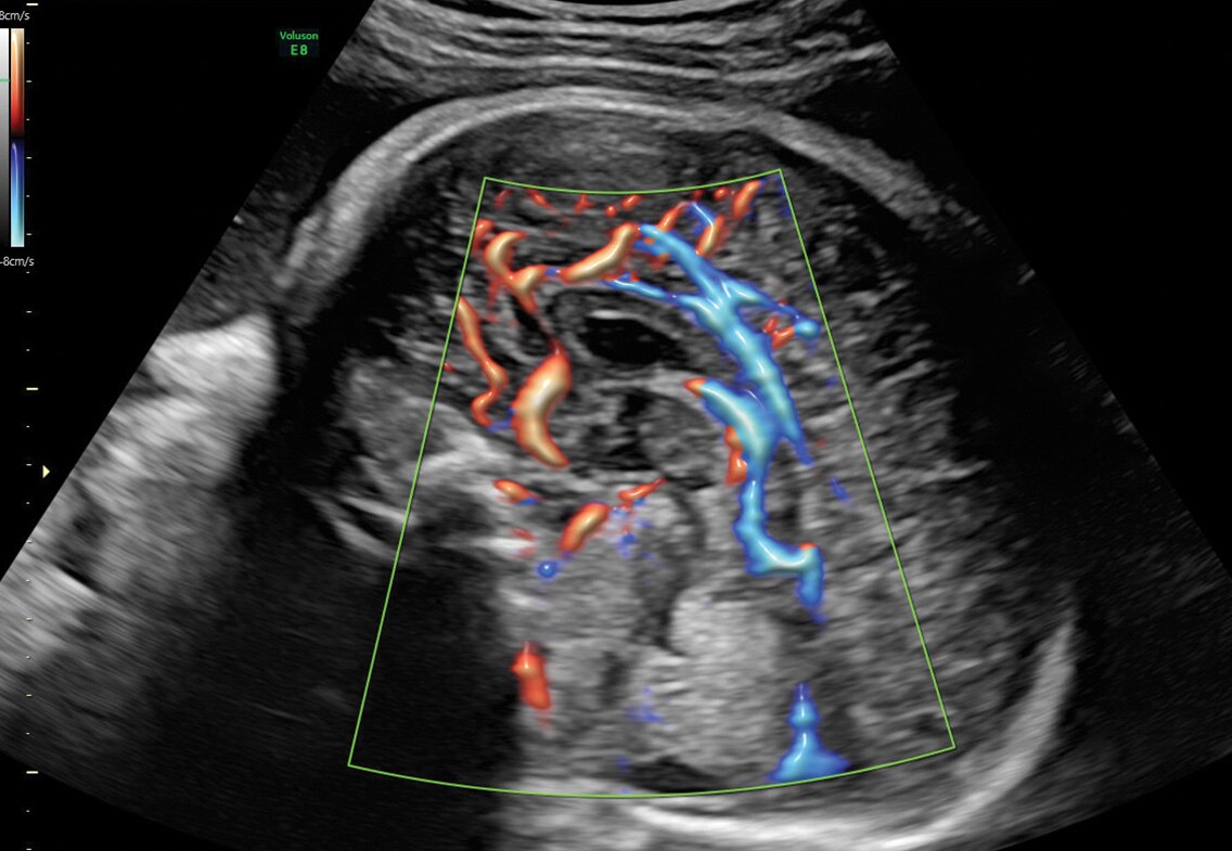 Voluson E8 | GE Healthcare