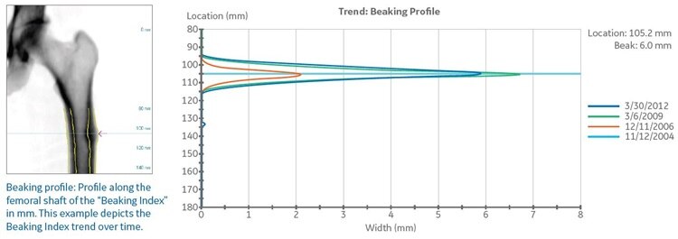 INCIPIENT ATYPICAL FEMUR FRACTURES | GE Healthcare (Malaysia)