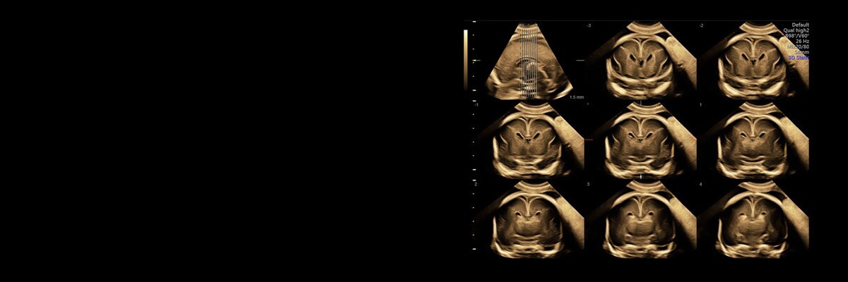 Obstetrics Exams - Voluson E10 - Voluson - Ultrasound - Products | GE ...