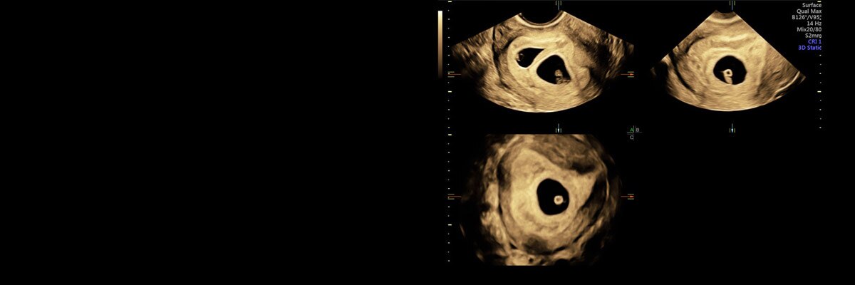 Advanced Probe Technologies - Voluson E10 - Voluson - Ultrasound ...