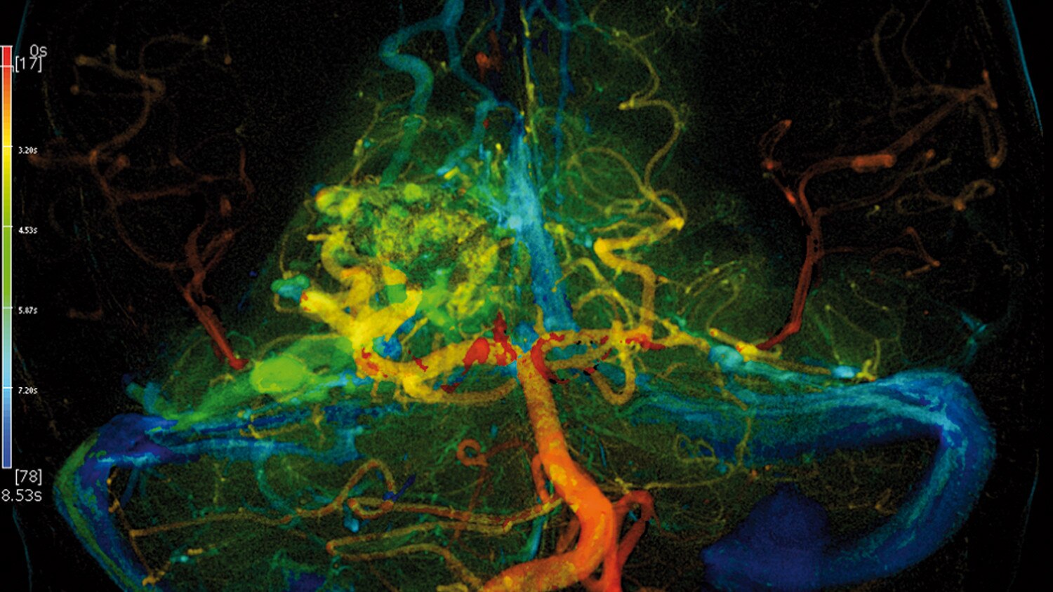 Vascular Advanced Visualization | GE Healthcare (Malaysia)