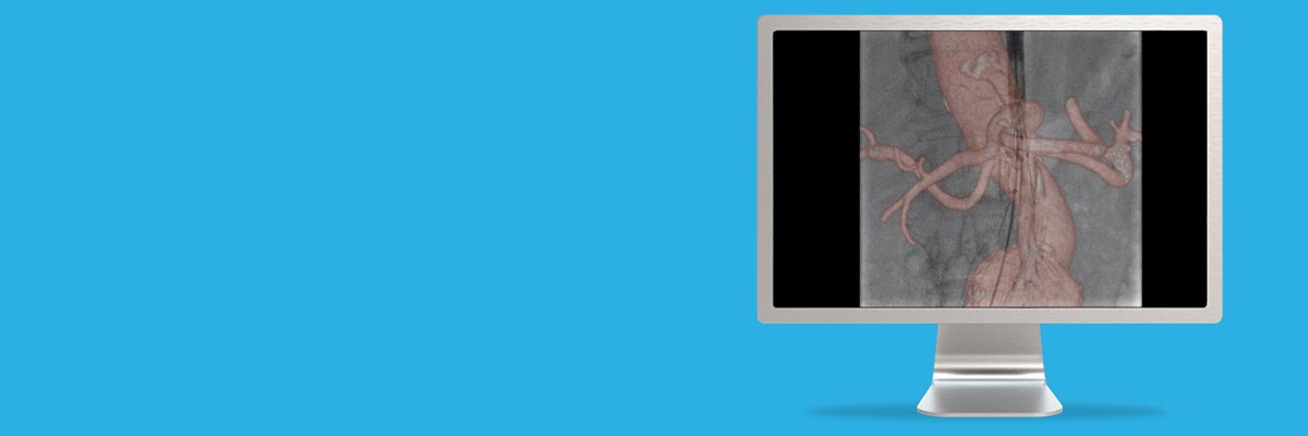 (T)EVAR Assist Solutions | GE Healthcare (Malaysia)