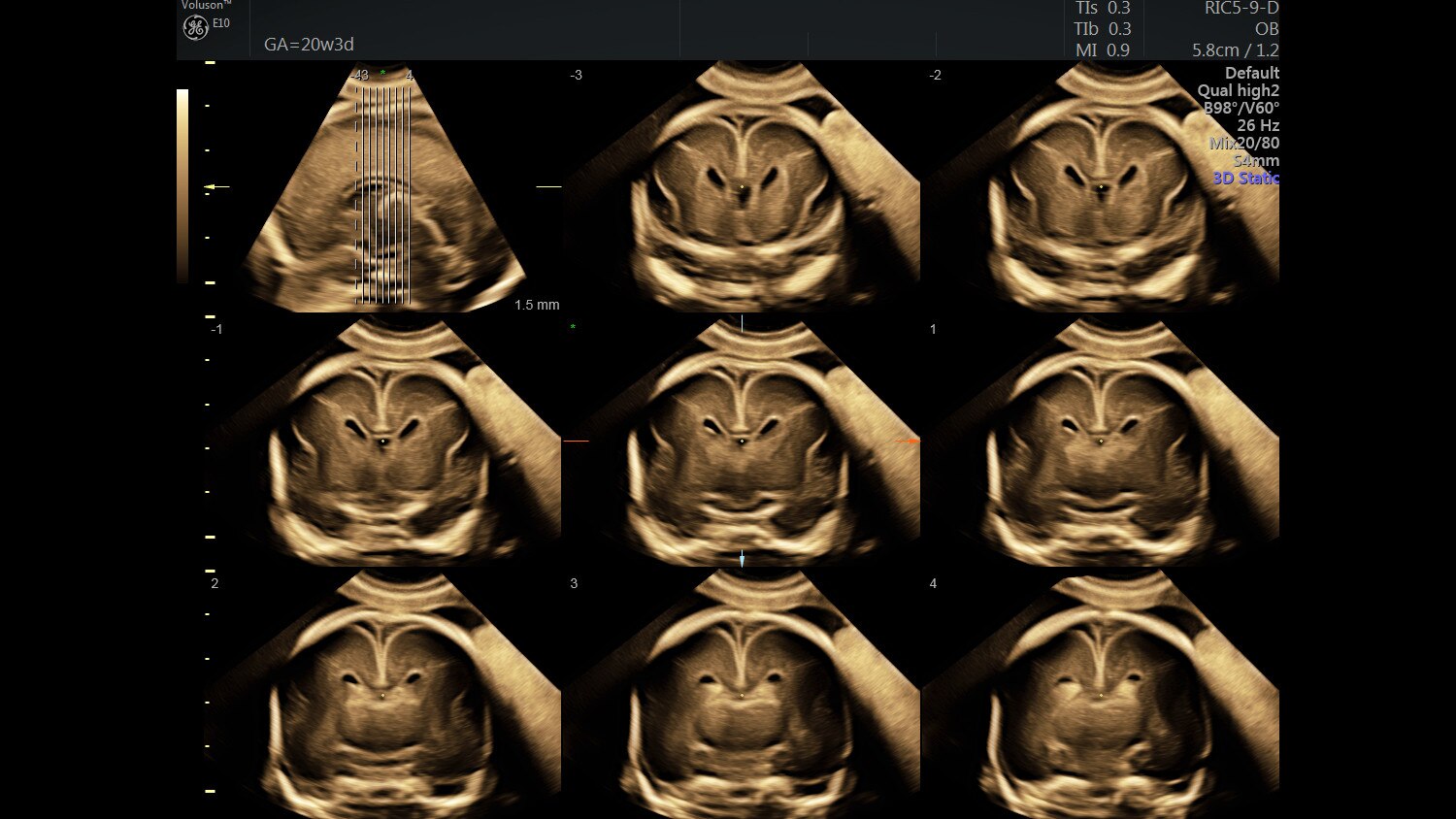 Gynecology - Voluson E10 - Voluson - Ultrasound - Products | GE ...