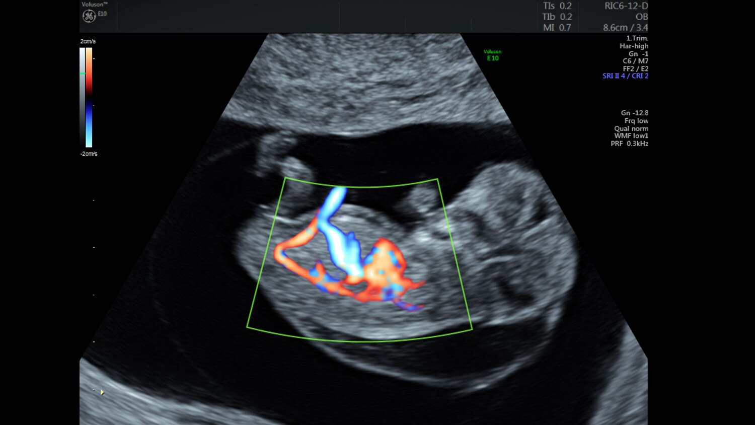 HDlive Innovations - Voluson E10 - Voluson - Ultrasound - Products | GE ...