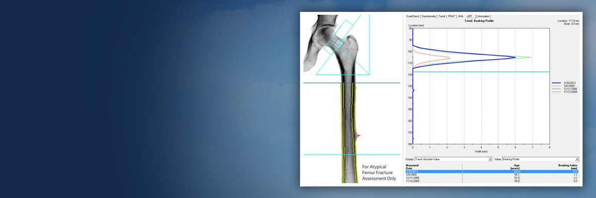 INCIPIENT ATYPICAL FEMUR FRACTURES | GE HealthCare (Singapore)