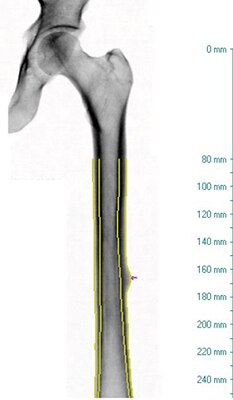 INCIPIENT ATYPICAL FEMUR FRACTURES | GE HealthCare (Singapore)