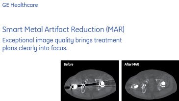 Smart Metal Artifact Reduction | GE Healthcare (Singapore)