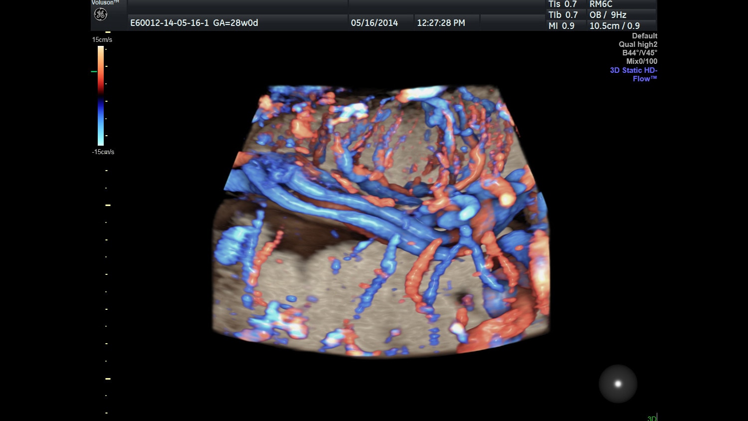 HDlive Innovations - Voluson E10 - Voluson - Ultrasound - Products | GE ...