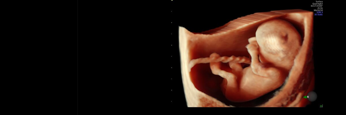 HDlive Innovations - Voluson E10 - Voluson - Ultrasound - Products | GE ...