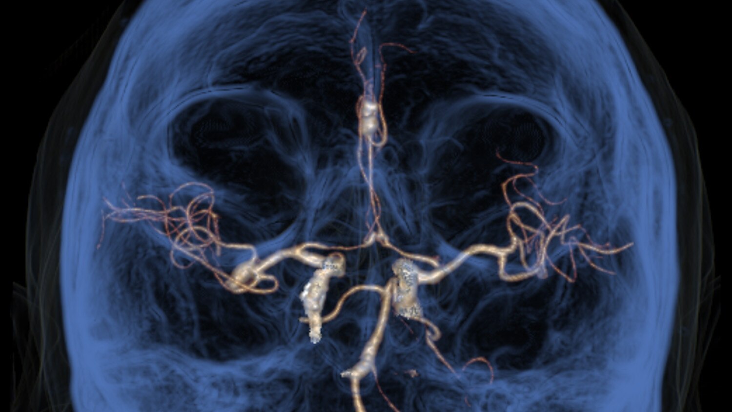 Vascular Advanced Visualization | GE Healthcare (Singapore)