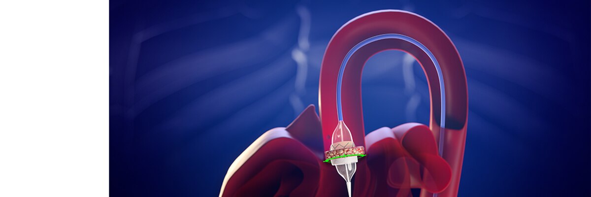 VALVE ASSIST | GE HealthCare (Thailand)