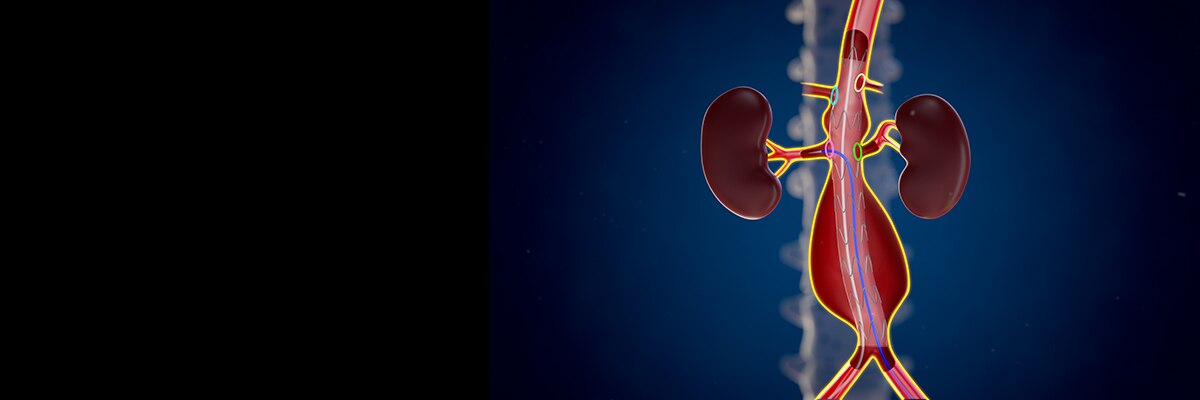 EVAR ASSIST | GE HealthCare (Thailand)