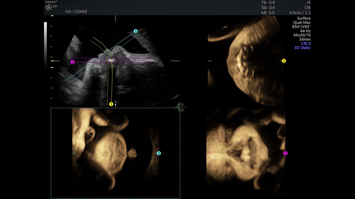Advanced Probe Technologies - Voluson E10 - Voluson - Ultrasound ...