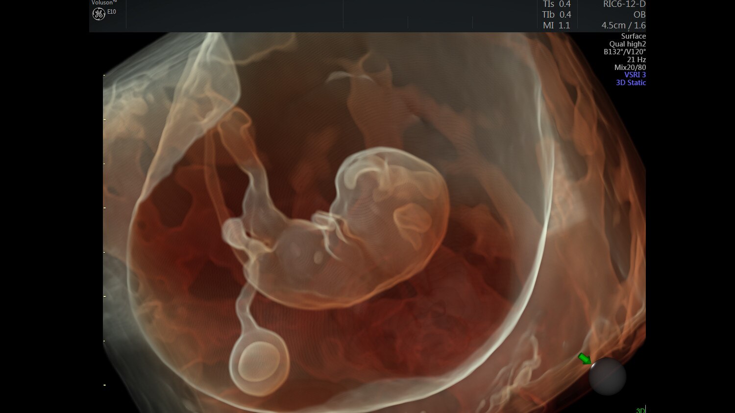 Advanced Probe Technologies - Voluson E10 - Voluson - Ultrasound ...